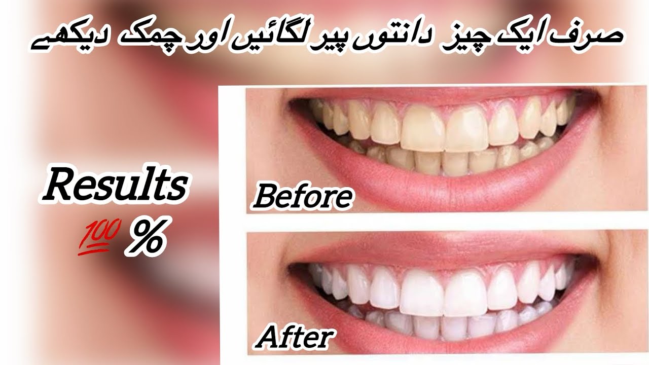 Fastest Way To Whiten Teeth At Home | Best Product I’ve Ever Seen For ...