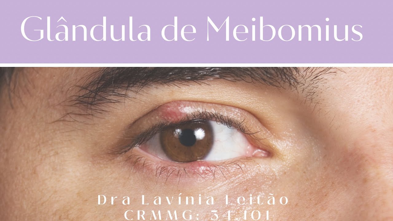 Glândula de Meibomius - Dra Lavínia Leitão - YouTube
