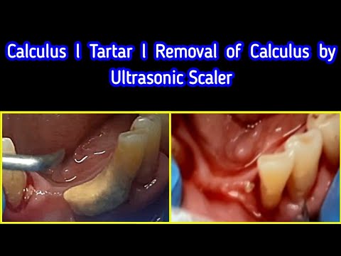 Calculus l Removal of Calculus l Calculus Removal by Ultrasonic Scaler ...