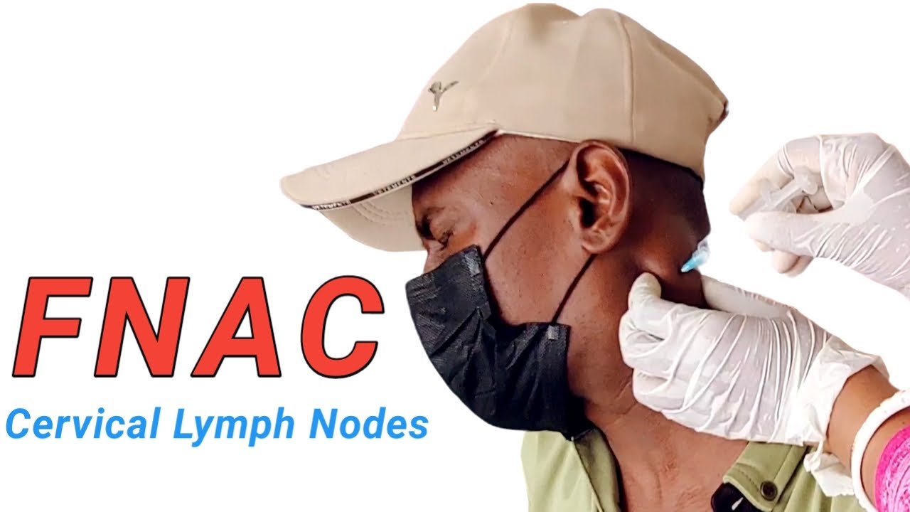 FNAC in The Diagnosis of Posterior Cervical Lymph Nodes।। - YouTube