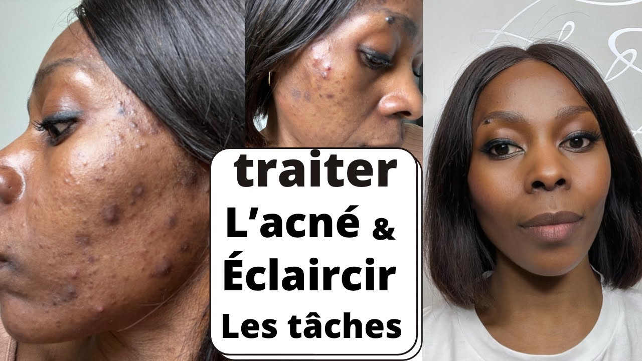 COMMENT SE DÉBARRASSER DE L'ACNÉ ET ÉCLAIRCIR LES TACHES SUR LE VISAGE ...