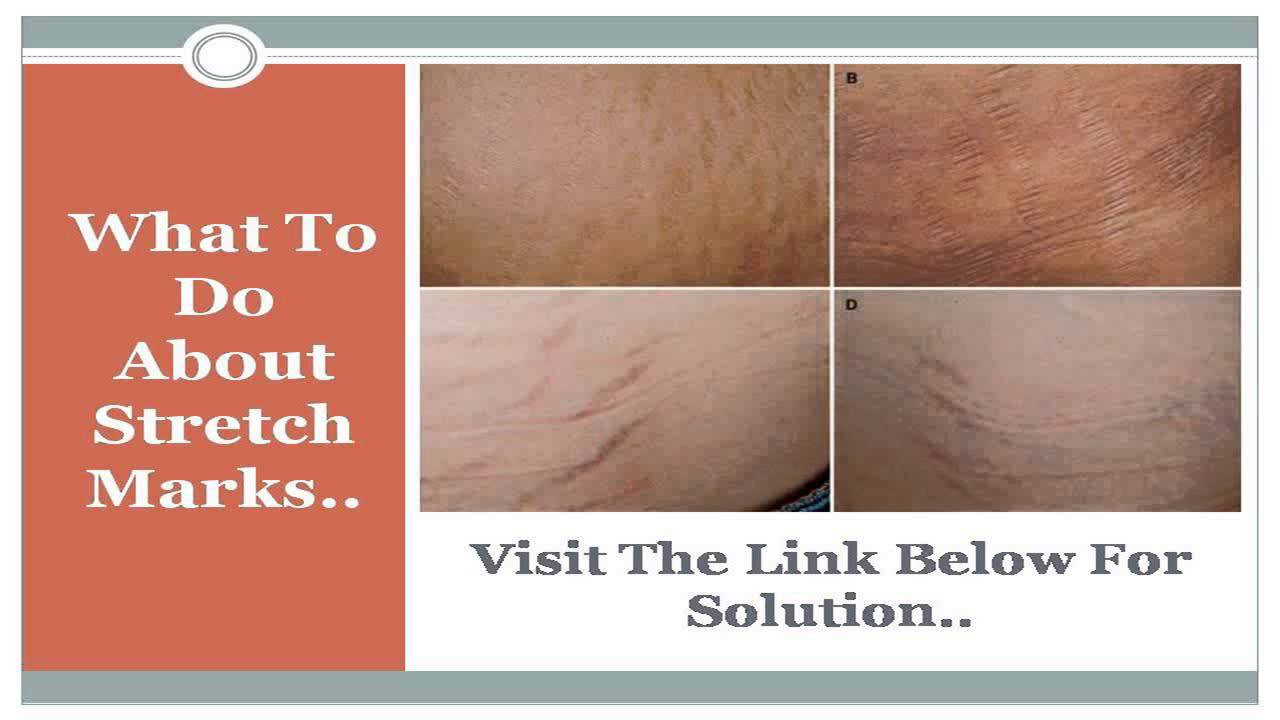 What to Do about Stretch Marks? - Best Treatment - YouTube