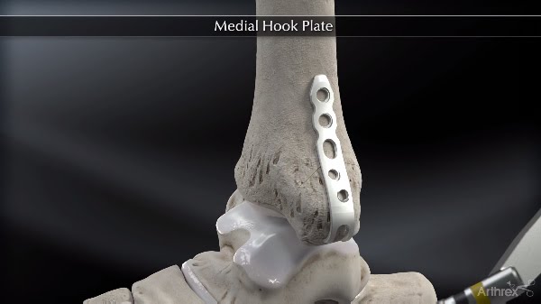 Medial Hook Plate - YouTube