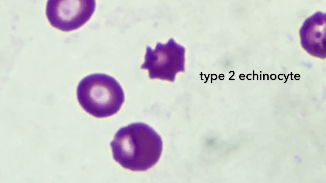 Echinocyte