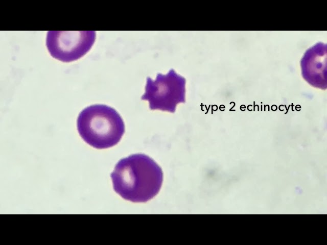 Echinocyte