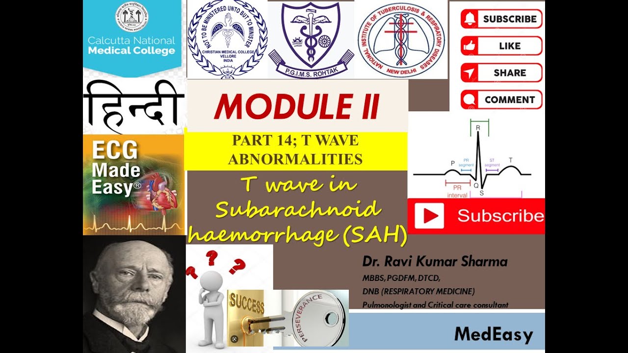 ECG made easy (हिन्दी) MODULE II. PART 14 (j); Inverted T wave in ...