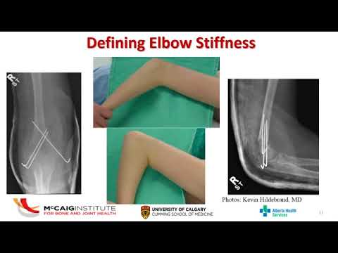 Exercises After Elbow Surgery - Fitness | NoahStrength.com