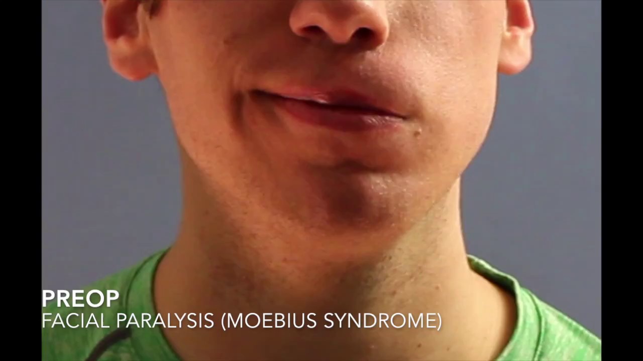 Lengthening Temporalis Myoplasty for Smile Reanimation - YouTube