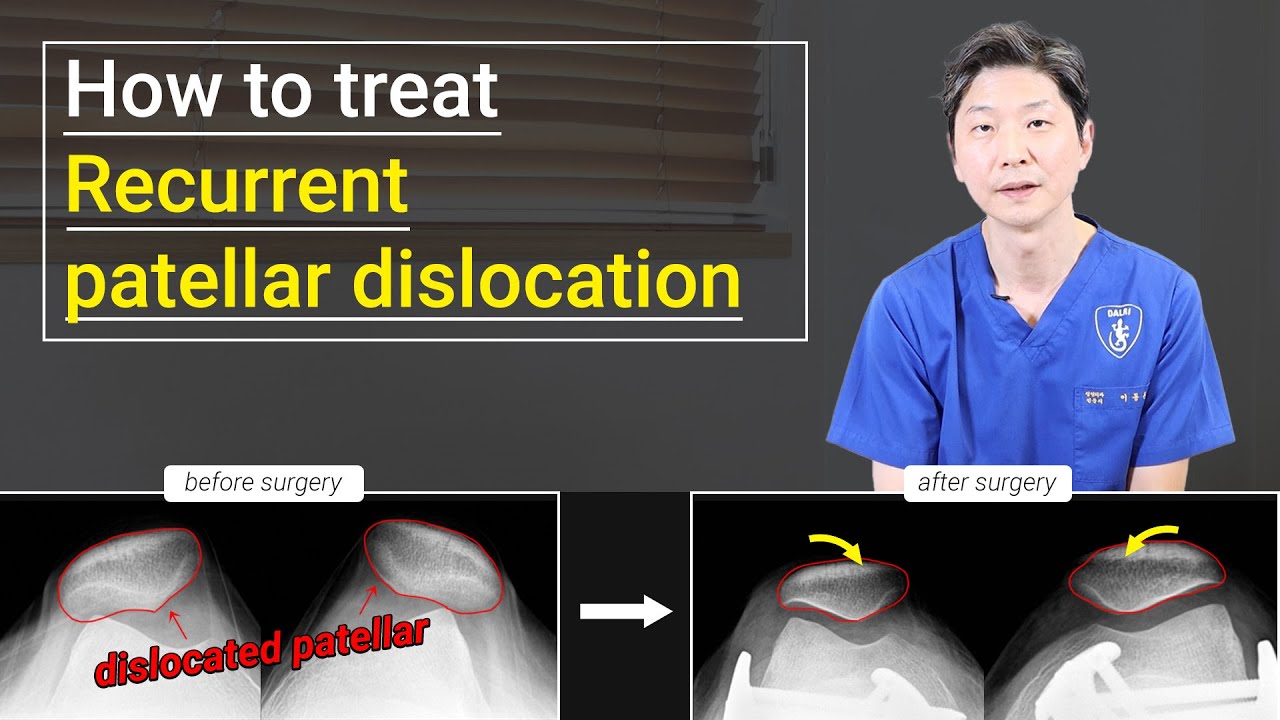 How to treat recurrent patellar dislocation?👨‍⚕️ - YouTube