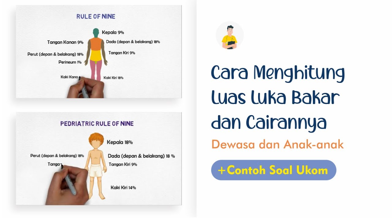 Cara Menghitung Luas Luka Bakar & Cairannya | Video Animasi - YouTube