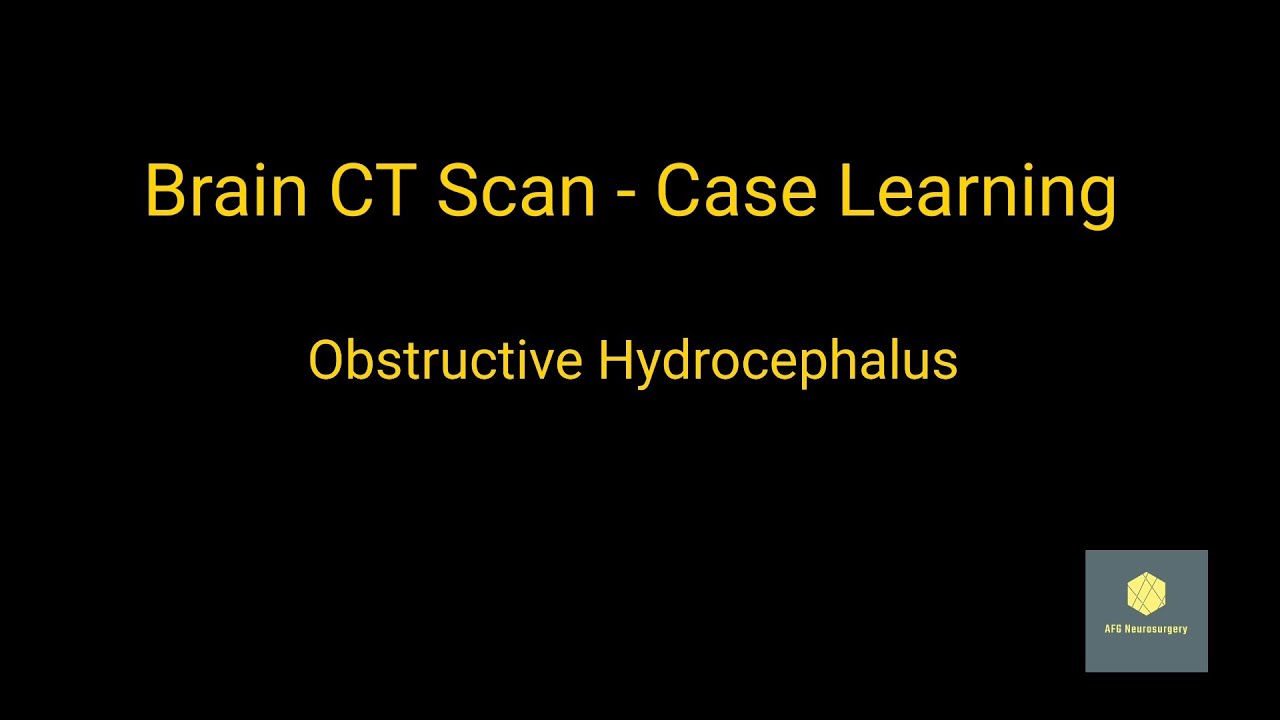 Obstructive Hydrocephalus (Brain CT Scan - Case Learning) - YouTube