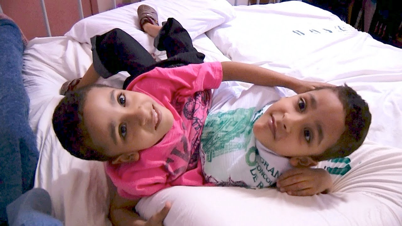 Conjoined Twins Await Separation - Body Bizarre Episode 6 Teaser - YouTube