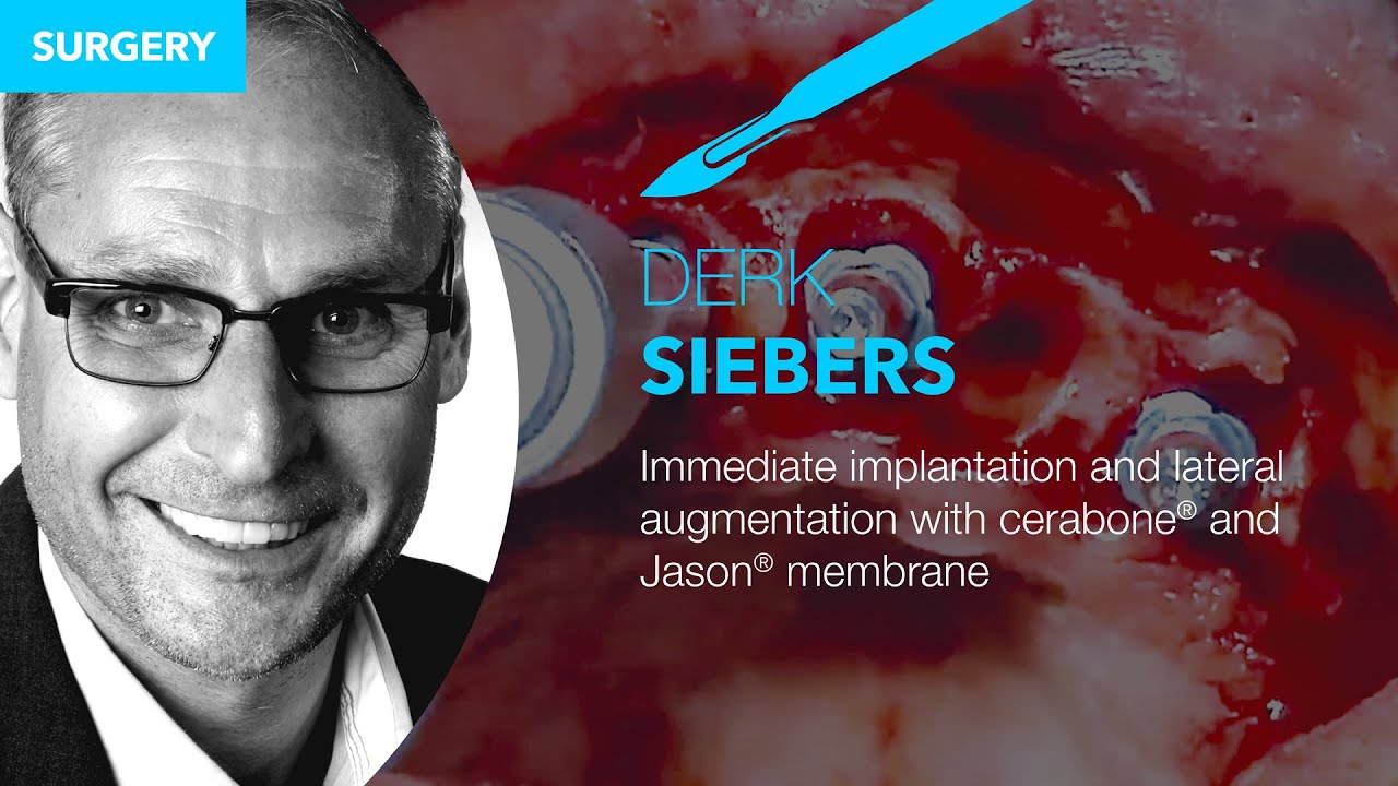 Immediate implantation and lateral augmentation with cerabone® and ...