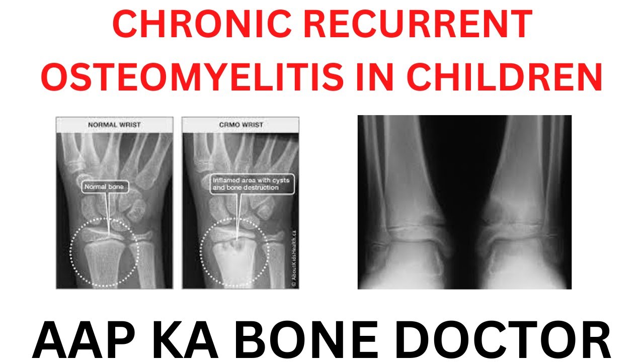 CHRONIC RECURRENT MULTIFOCAL OSTEOMYELITIS IN CHILDREN - EPISODE 64 ...