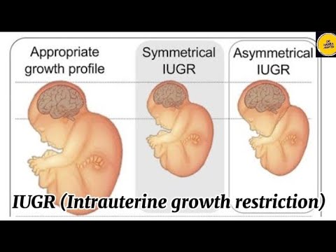 Intrauterine growth restriction causes | IUGR complete explanation ...