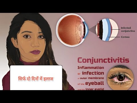 Conjunctivitis sign, symptoms and treatment(आंख आनें के लक्षण,और घरेलू ...