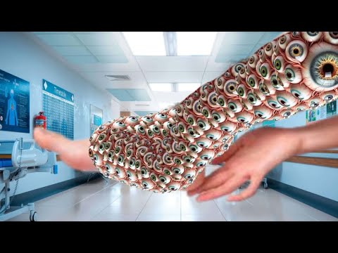 ASMR Animation!: Chin Ingrown deep cleaning maggots worm & Pimple ...