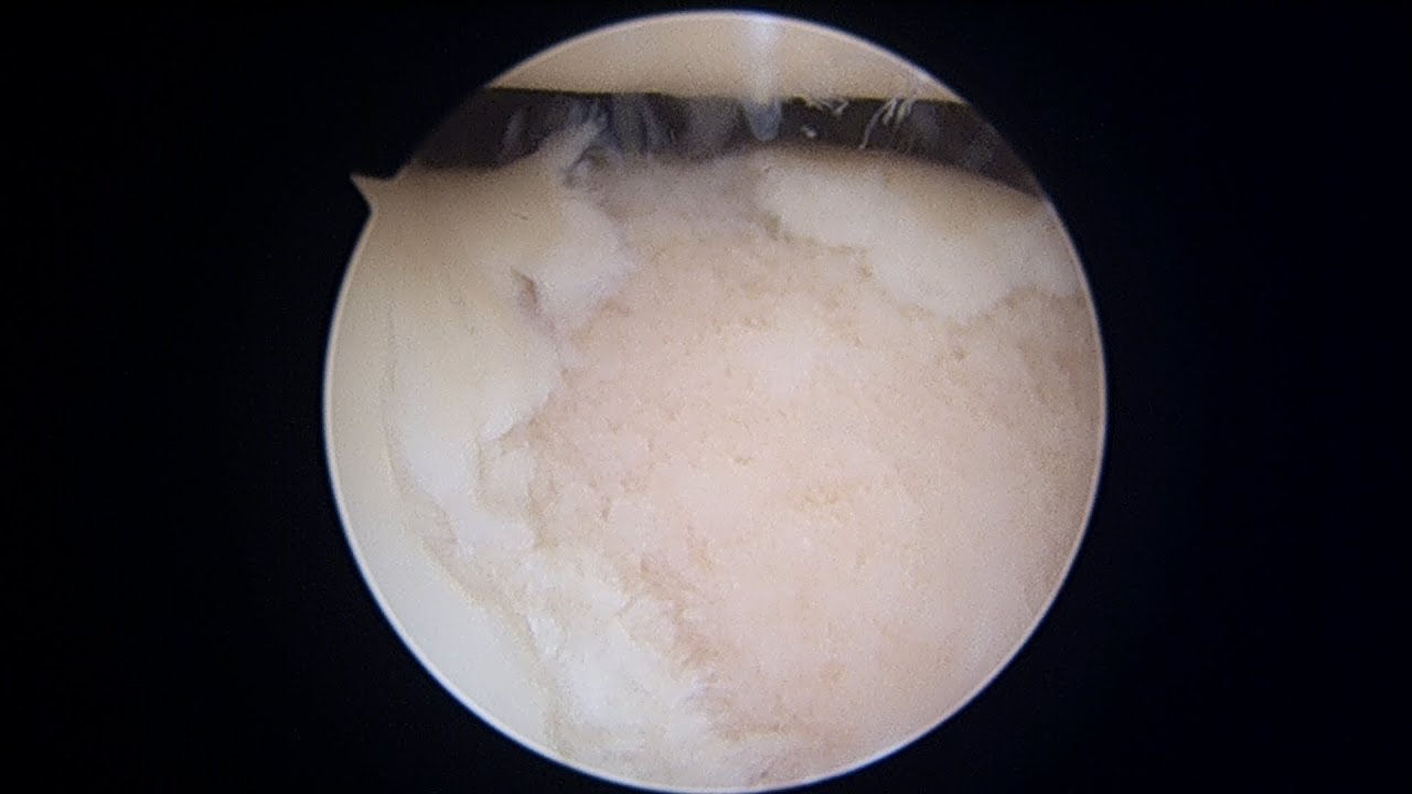 Arthroscopic debridement + microfracture + loose bodies retrieval - YouTube