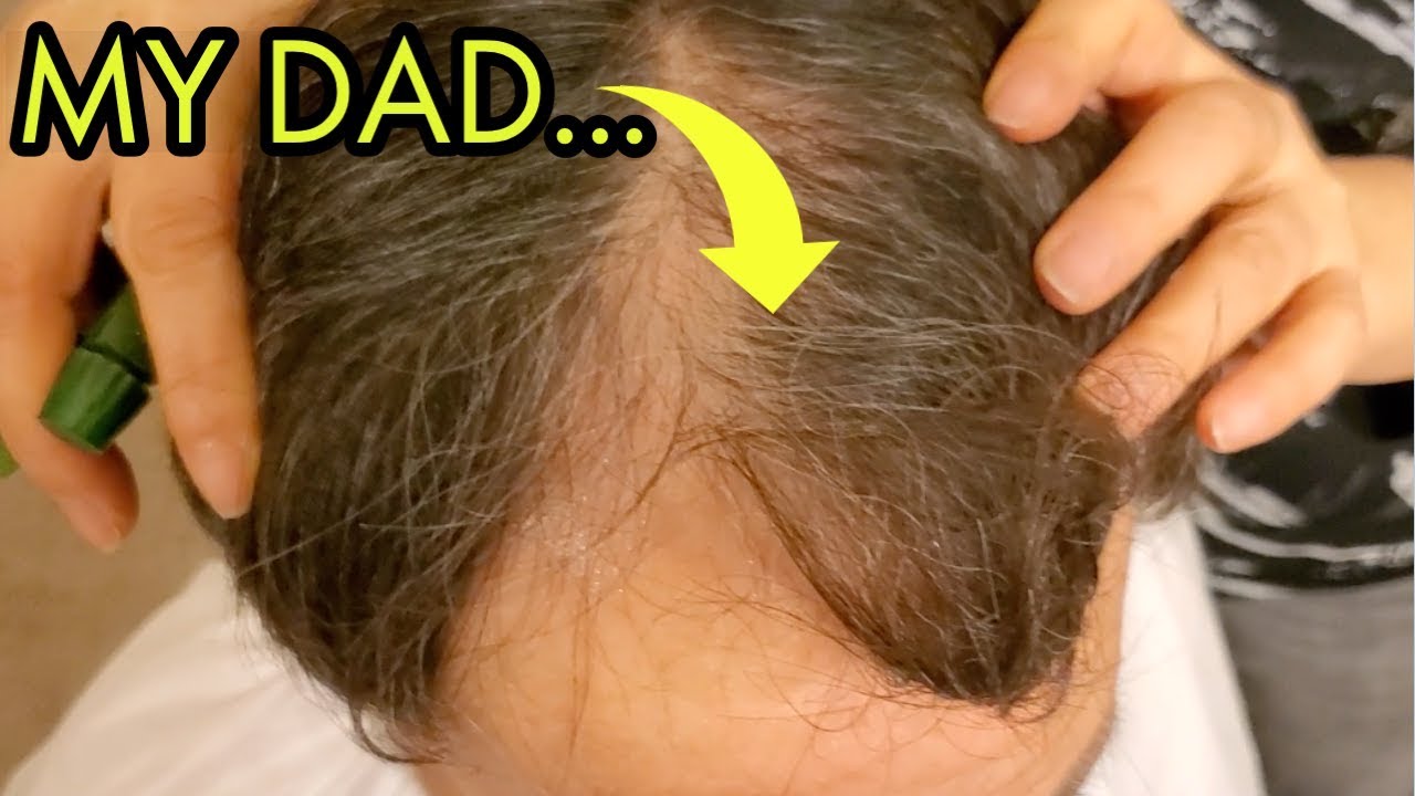 A LOOK INSIDE MY FAMILY HISTORY OF MALE PATTERN BALDNESS - YouTube