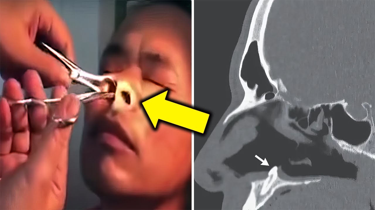 Man Has Intense Itch For Years. What Doctors Found In His Nose Is ...