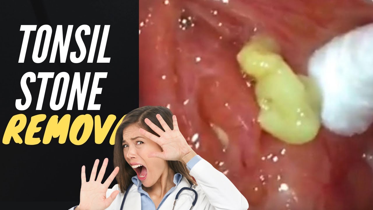 Tonsil Stone Removal Causes and Treatment | What Are Tonsil Stones ...