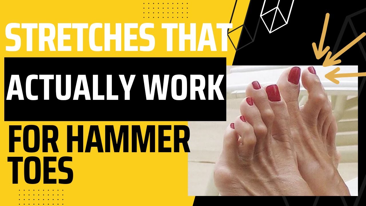Stretches that ACTUALLY WORK for Hammertoes! - YouTube