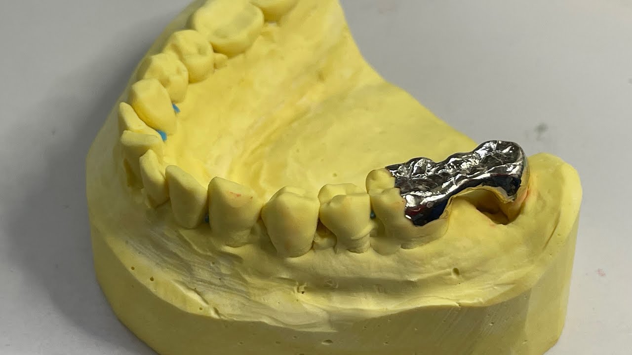 Full cast gold restoration work by Fumio Shima - YouTube