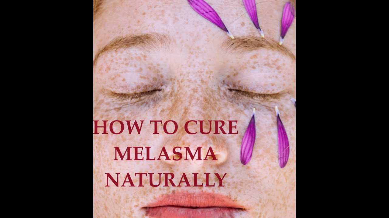 How To Cure Melasma/Hyperpigmentation Naturally - YouTube