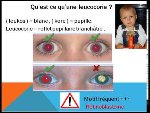 Conduite pratique devant une leucocorie chez l'enfant - YouTube