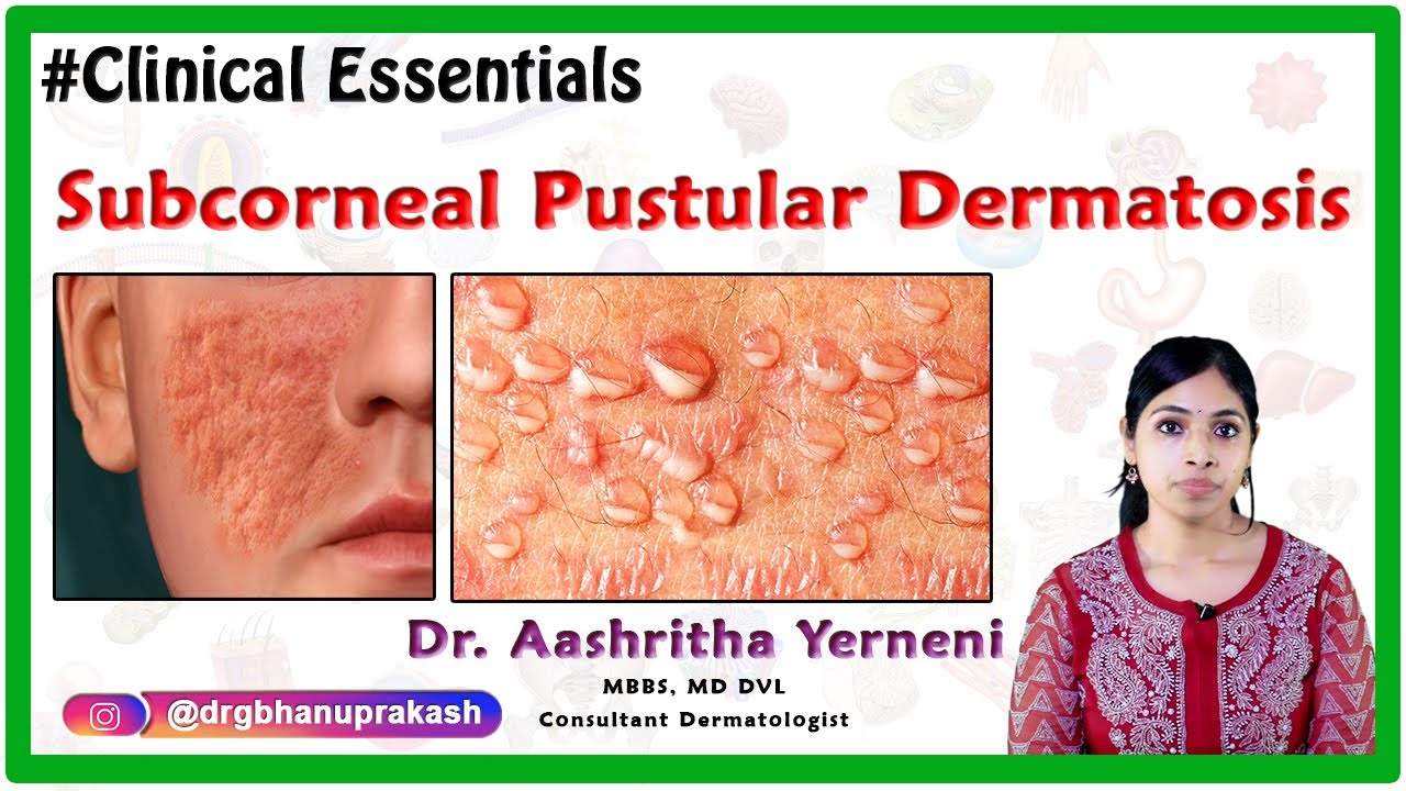 Subcorneal Pustular Dermatosis ( Clinical Essentials ) : Dr. Aashritha ...