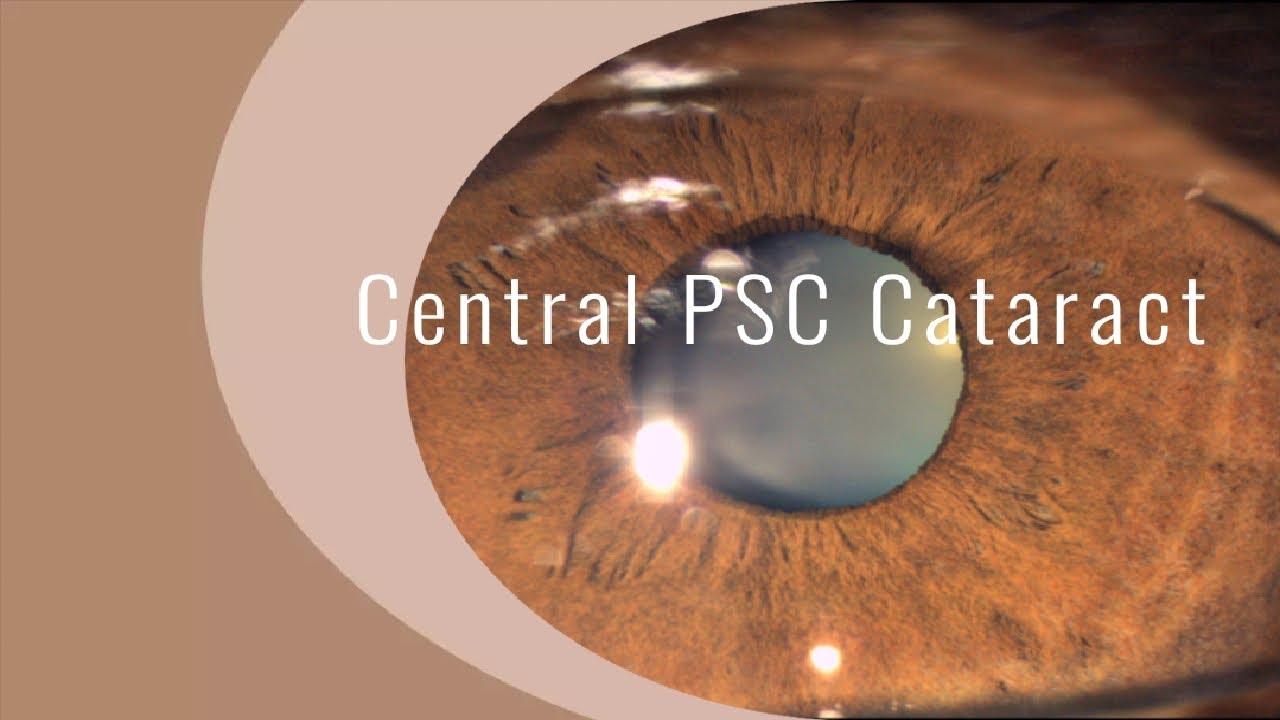 Central PSC Cataract Operation - YouTube