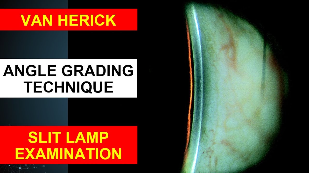 Van Herick Slit Lamp Technique | Angle Grading Technique | Anterior ...