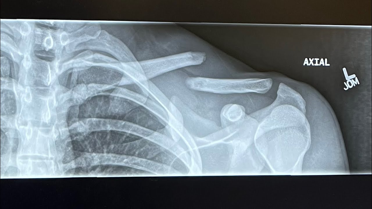 So you broke your collarbone? (Story of a fractured clavicle from a ...