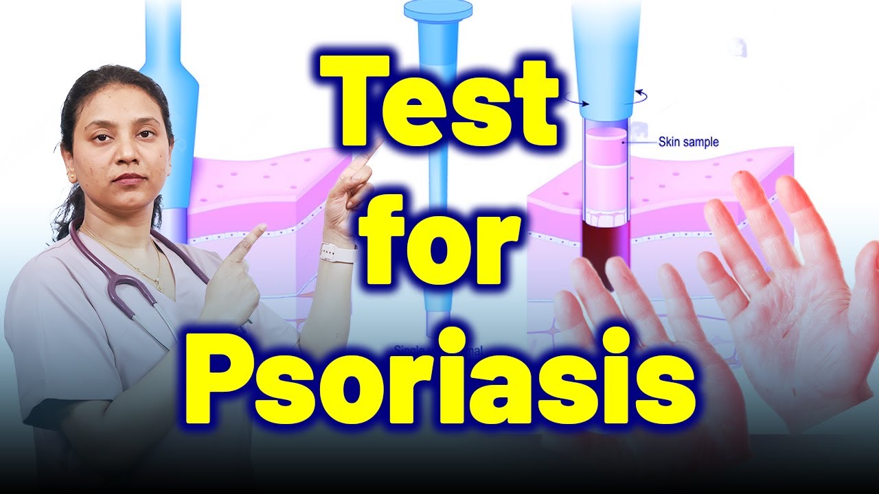 Test for Psoriasis. | Treatment and Cure | Homeopathy, Medicine ...