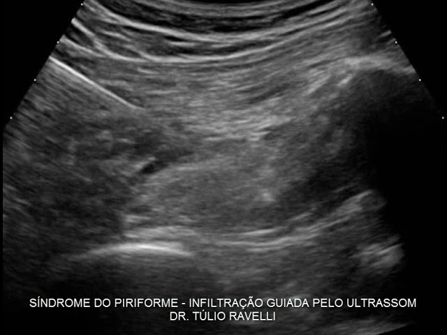 Ultrassonografia Sindrome Do Piriforme Paincare Síndrome Do