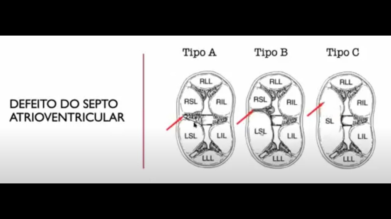 Defeito do septo atrioventricular (DSAV) - definição, classificação e ...