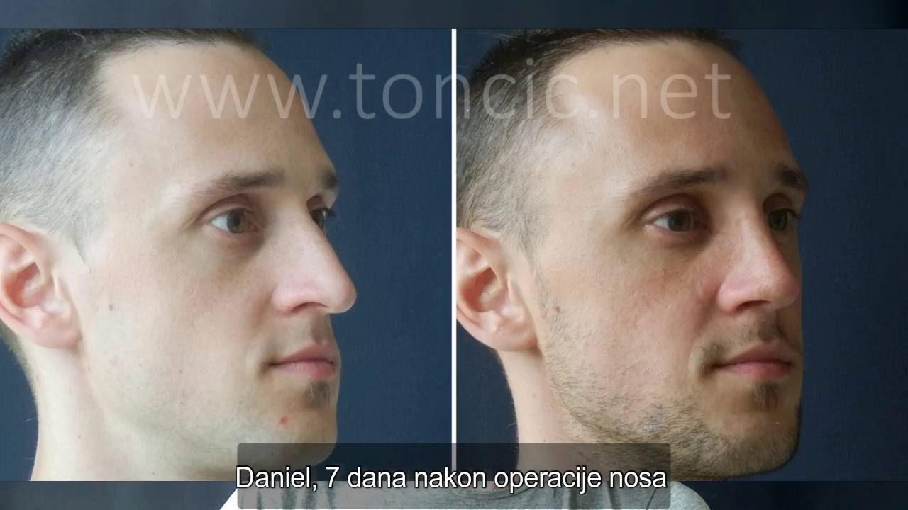 Operacija nosa: komentari pacijenta sa slikama prije i poslije ...