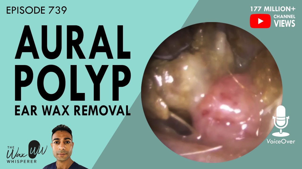 739 - Infected Aural Polyp Ear Wax Removal - YouTube
