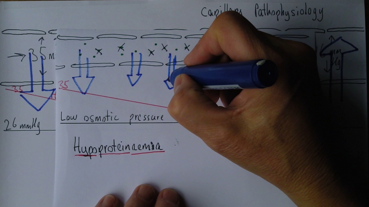 Capillaries 6, Hypoproteinemia - YouTube