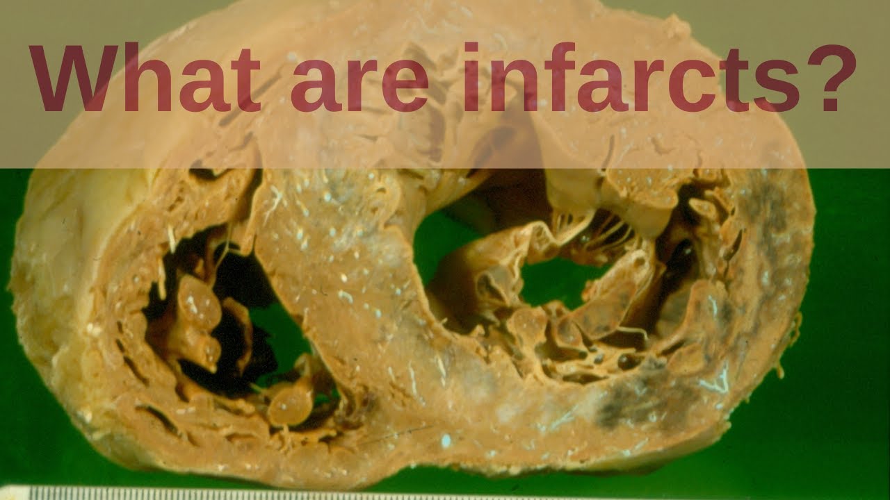 What is an Infarct? - Pathology mini tutorial - YouTube