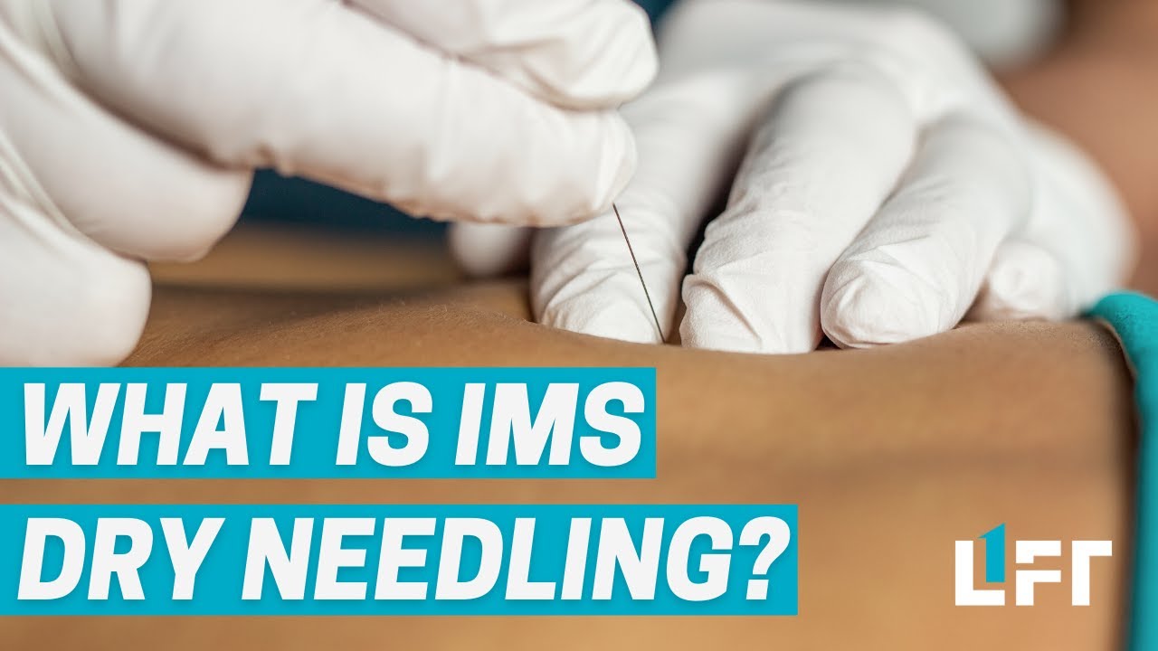 IMS Dry Needling With Your Vancouver Physiotherapist - Everything You ...