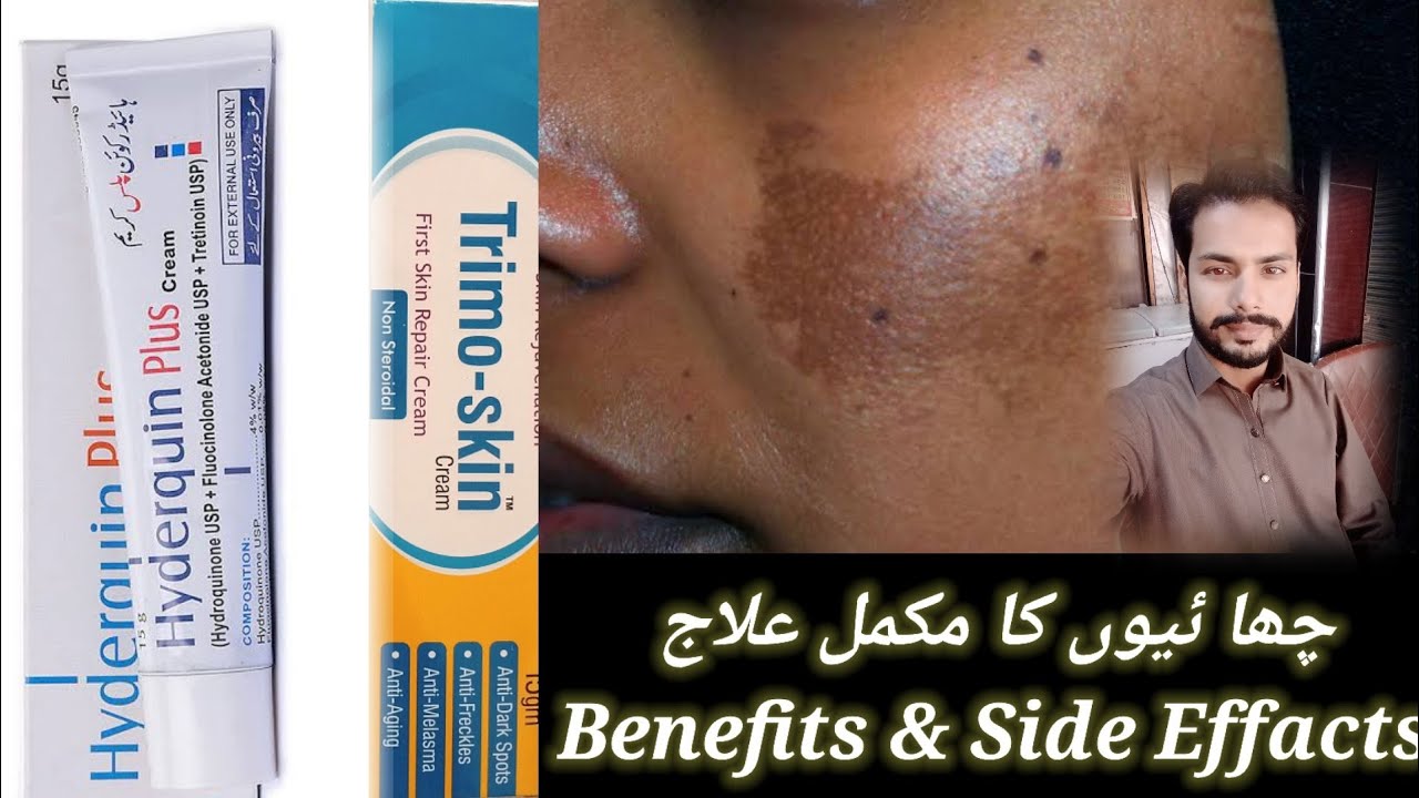 Trimo Skin Cream | How to use | Benefits side effacts چھا ئیوں کا مکمل ...