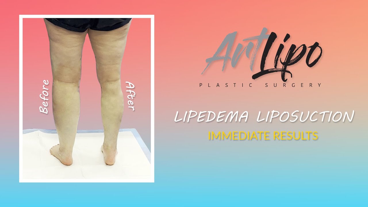 Lipedema Leg Liposuction Surgery | Cankles & Knees | Immediate Results ...