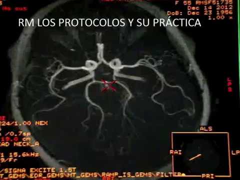 Reconstrucción Willis máquina - YouTube