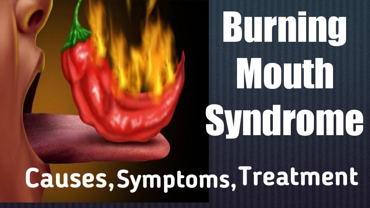 Burning Mouth Syndrome Treatment Current Management Strategies For The