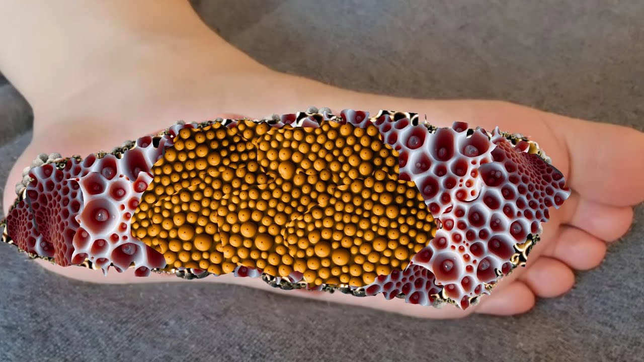 Asmr ! removing yellow triphobia pimples broyozoan from foot |2d ...