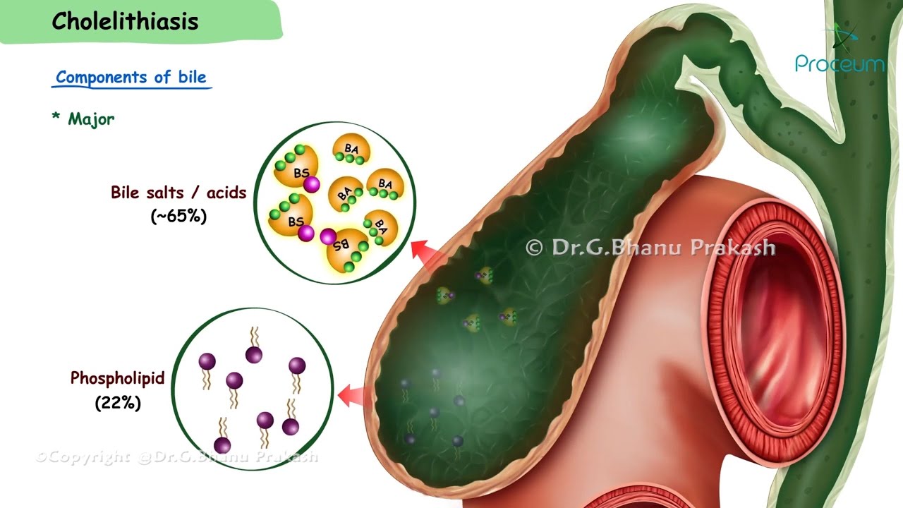 Gallstones (Cholelithiasis) Animation: Types, Clinical features ...