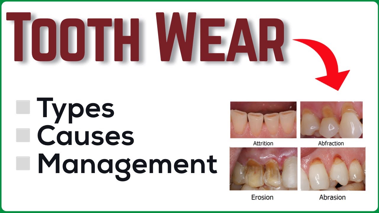 TOOTH WEAR - Types, Causes & Management - YouTube