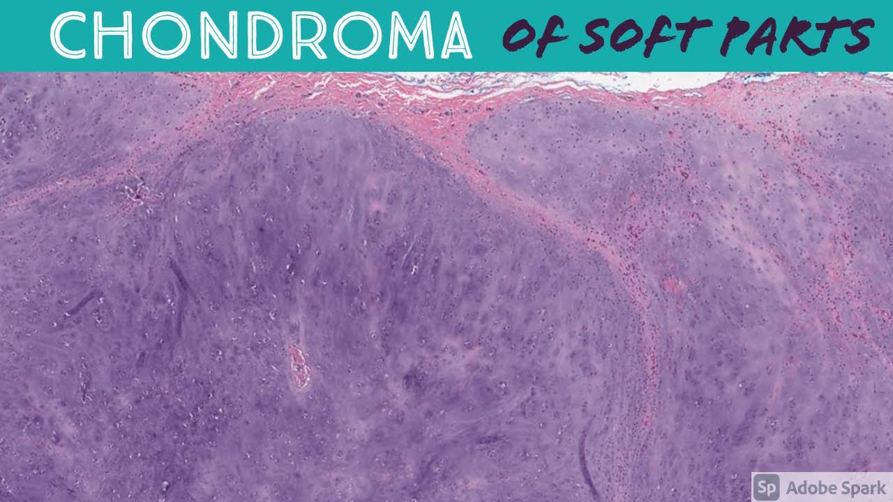 Chondroma of Soft Parts (Extraskeletal Chondroma) - YouTube