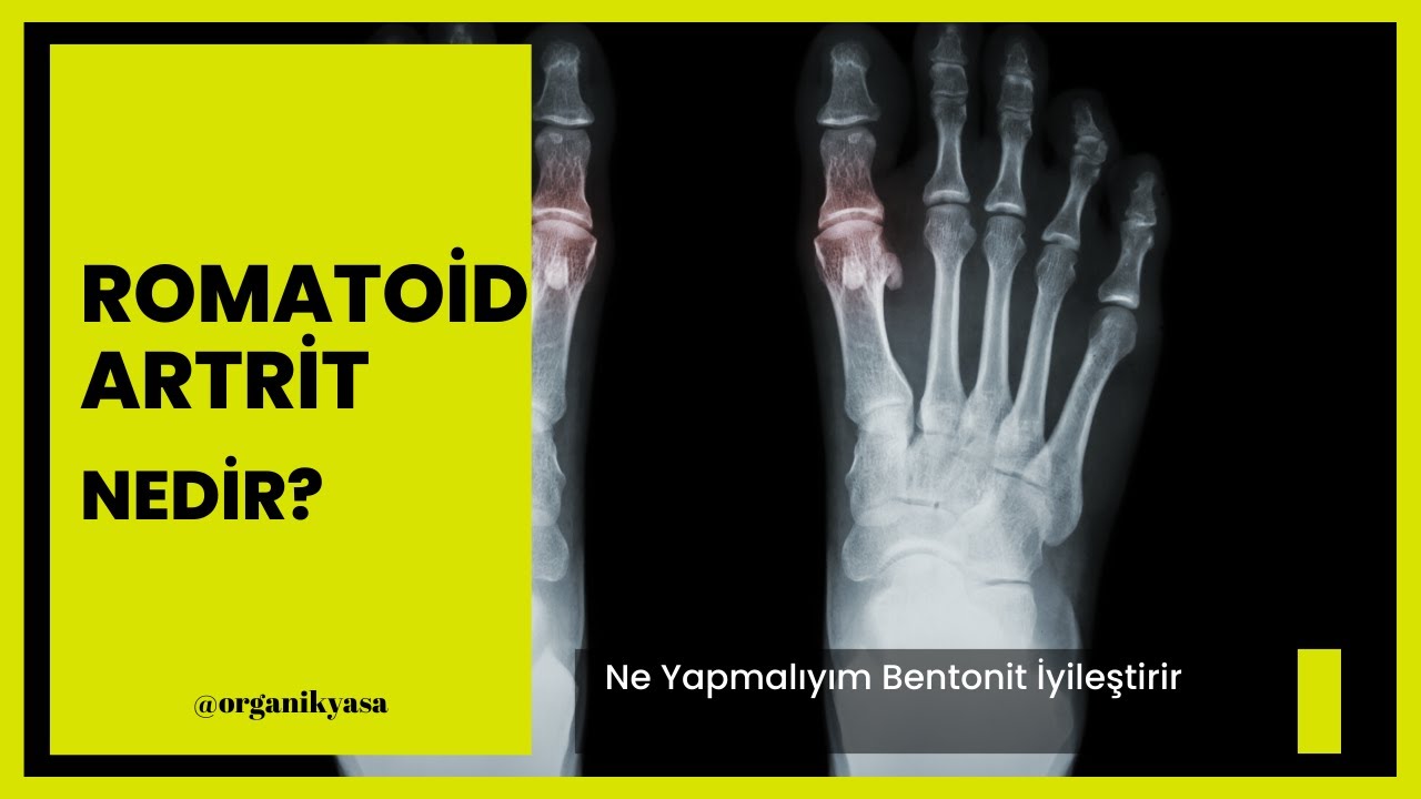 Romatoid Artrit iltihaplı romatizma neden olur Bentonit nasıl fayda ...